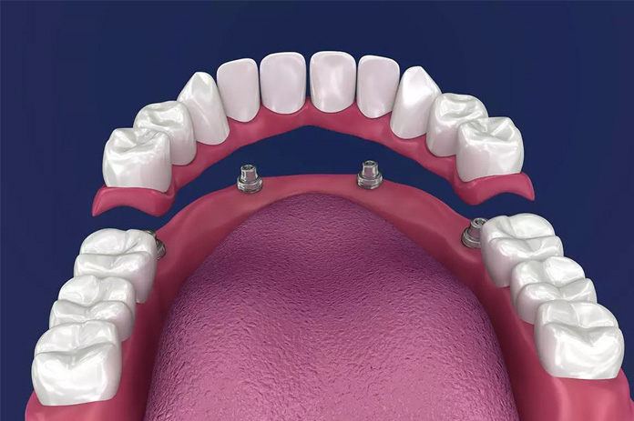 Implant Retained Dentures Alexandria VA - Carabella Dental