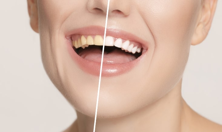 ¿Es el pulido de dientes lo mismo que el blanqueamiento dental?