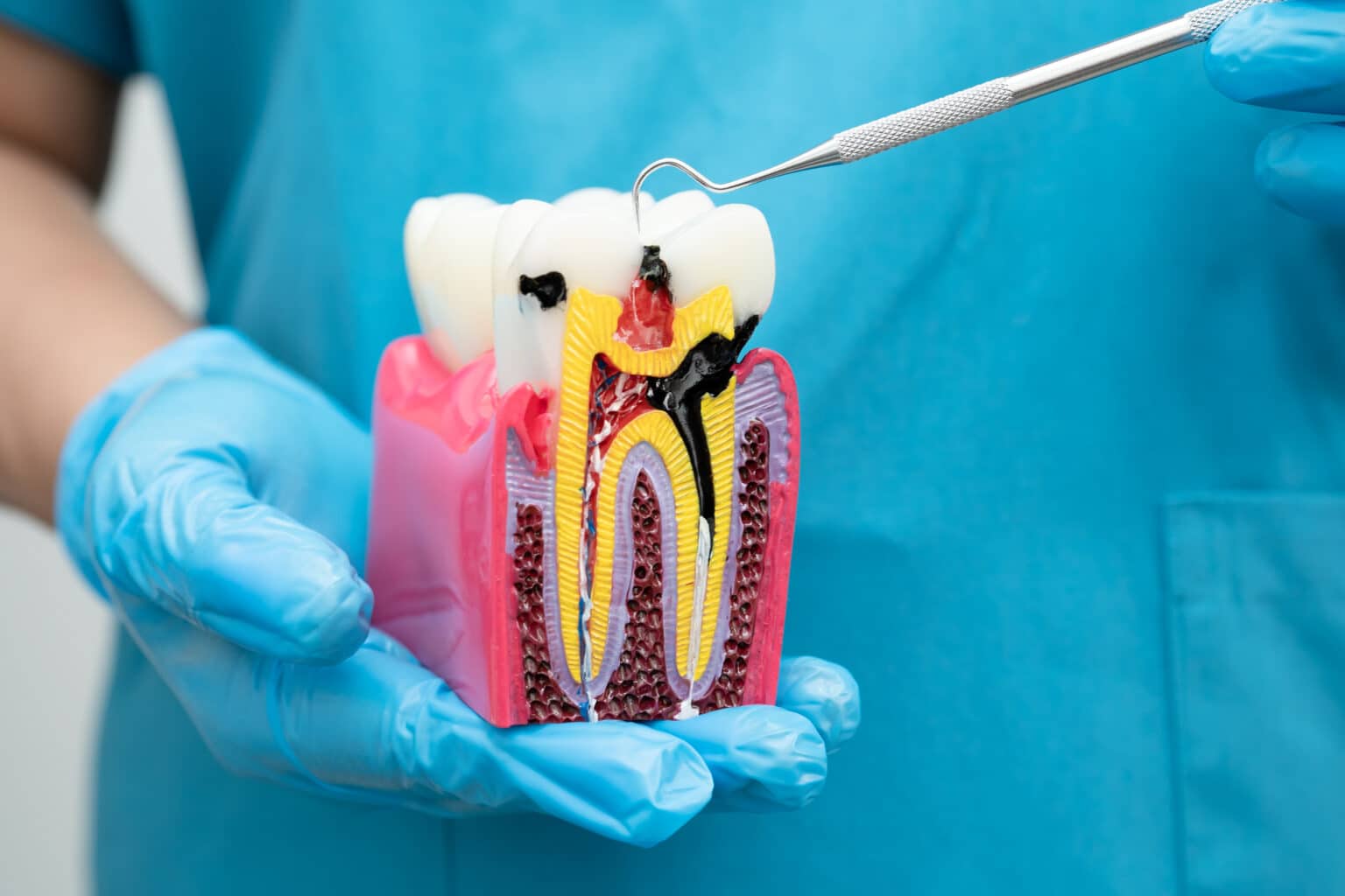9 consejos esenciales para el cuidado posterior de una endodoncia sin ...